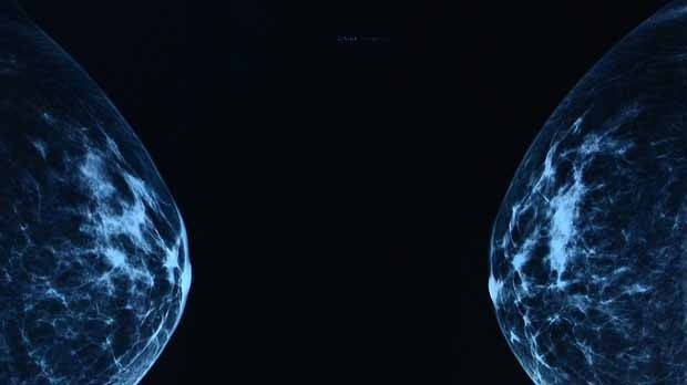 Breast-friendly, radiation-free alternative to mammograms in the works